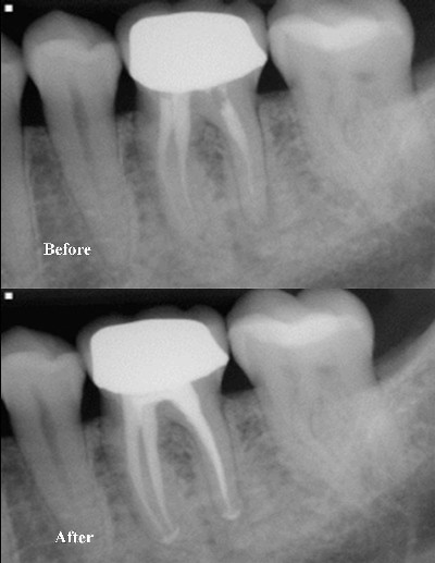 Non-Surgical Retreatment Cases - Reno Endodontics
