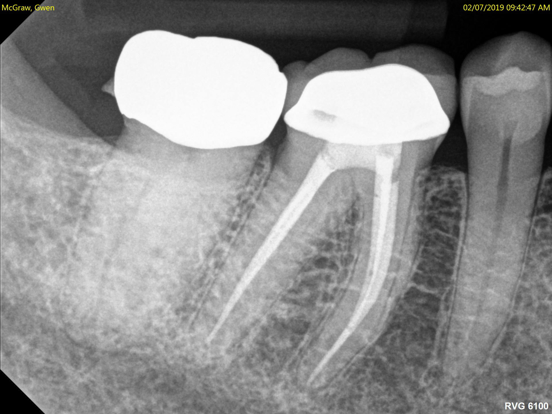Interesting Endodontic Cases - Reno Endodontics