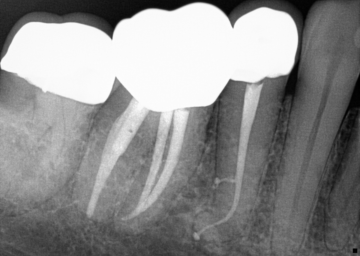 Interesting Endodontic Cases - Reno Endodontics