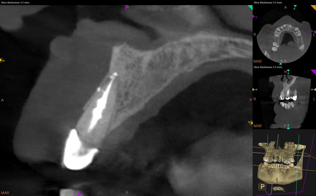 Interesting Endodontic Cases - Reno Endodontics